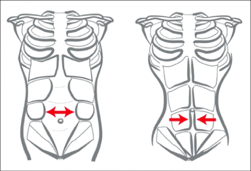 Diastasis Recti - Physiotherapy Blog | Orleans Physiotherapist | Motion ...