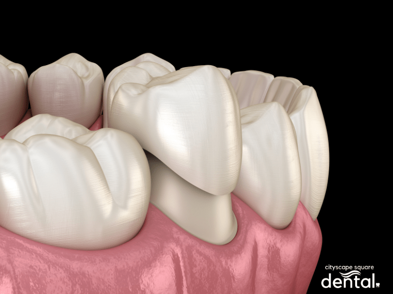 The Art of Tooth Restoration: Exploring Dental Crowns - Cityscape ...