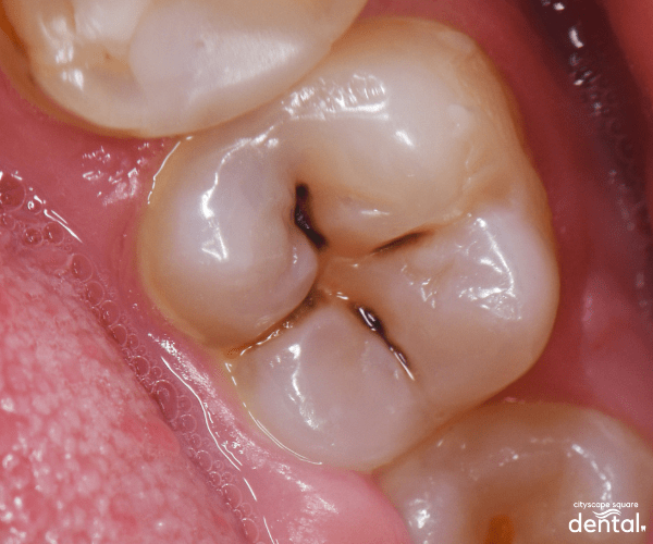 Pain or Relief? A Guide to Dental Fillings and Cavity Treatment ...